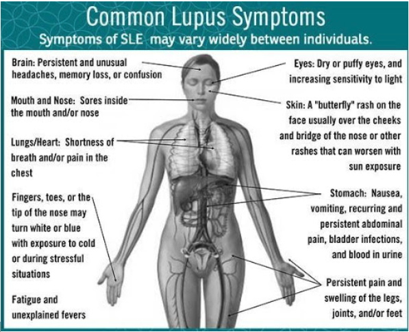 Lupus – The EPIC Foundation